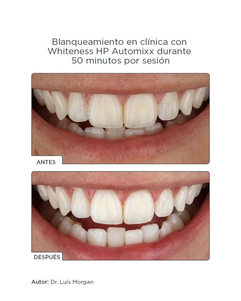Conozca el blanqueador dental automezcla Whiteness HP Automixx — Perú ...