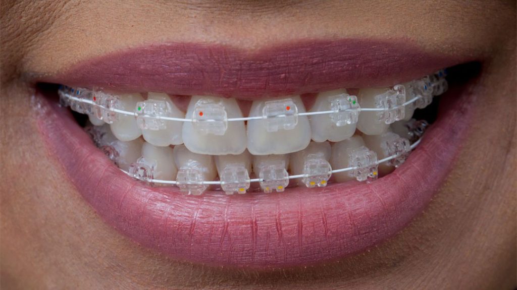 Bracket Estético BioCrystal — ADITEK | Perú Dentistry